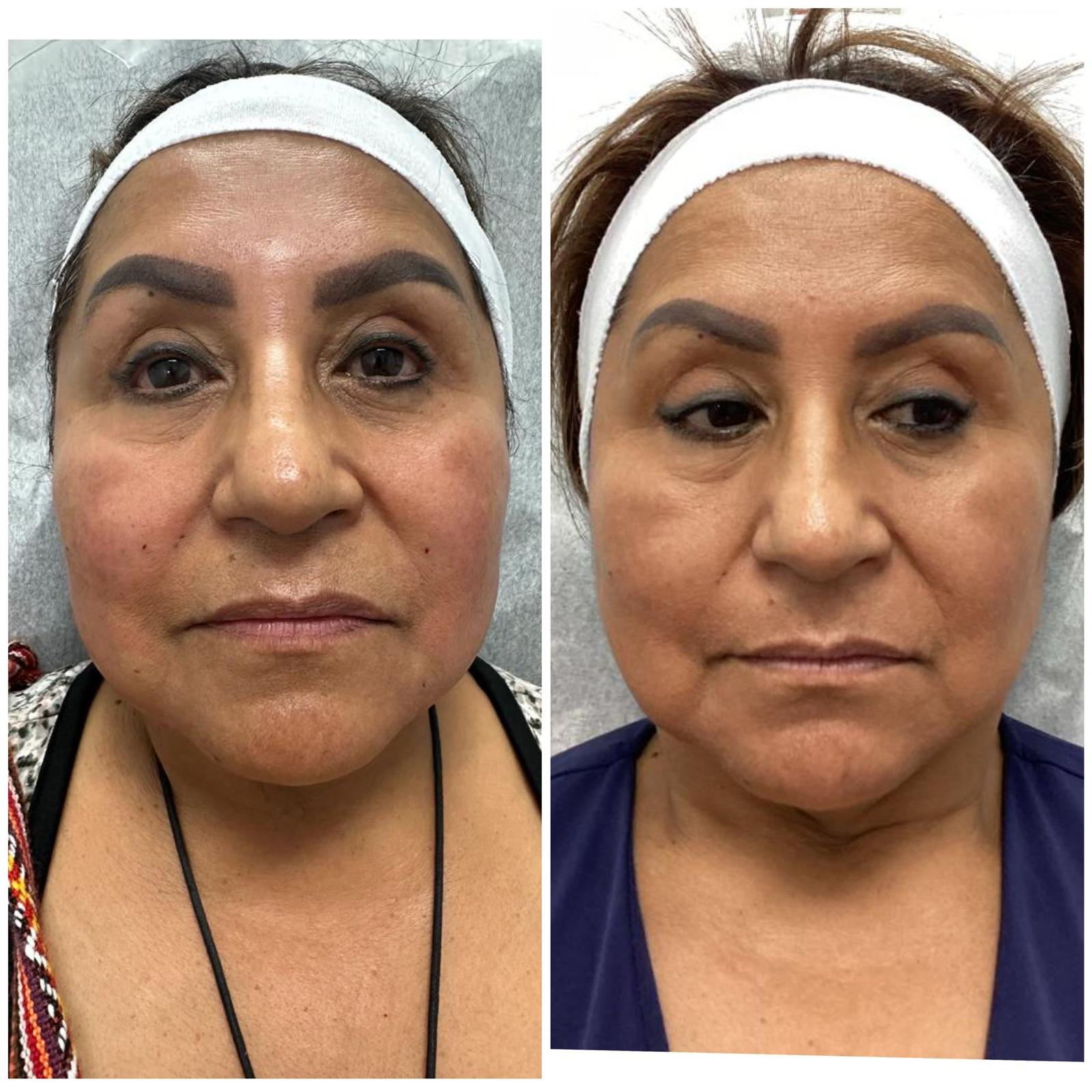 PDO Threading – MD Ageless Solutions