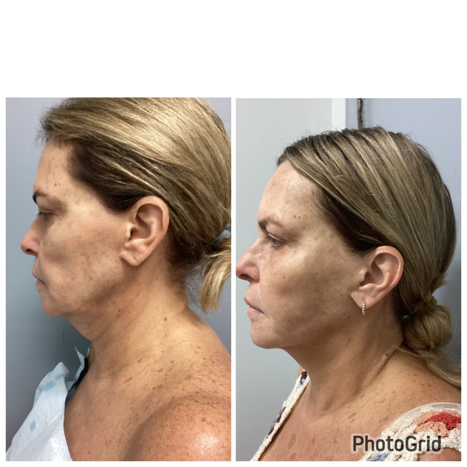 MD Ageless: Non-Surgical Neck Lift for Neck Rejuvenation